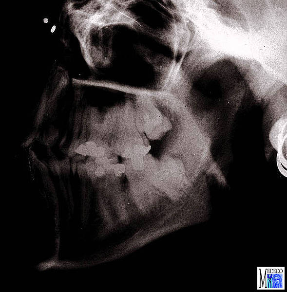 Maxilläre Prognathie