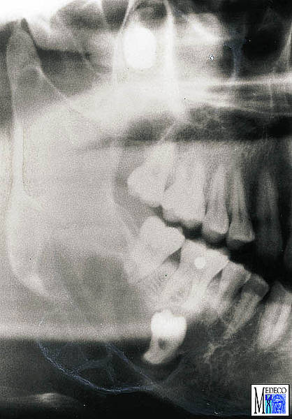 Odontogene Zysten