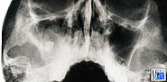 Odontogene Zysten