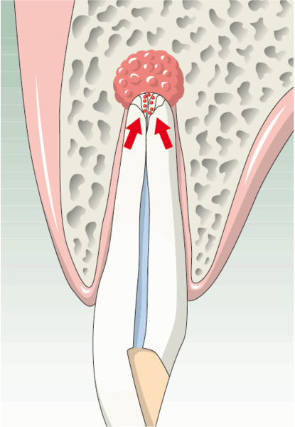 Root tip resection