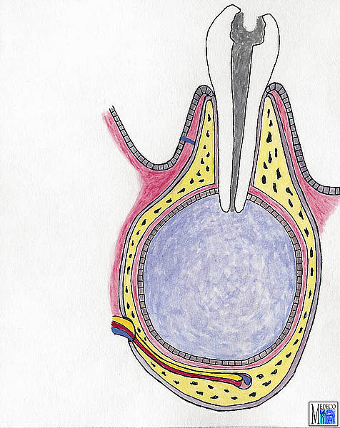 Radicular cysts