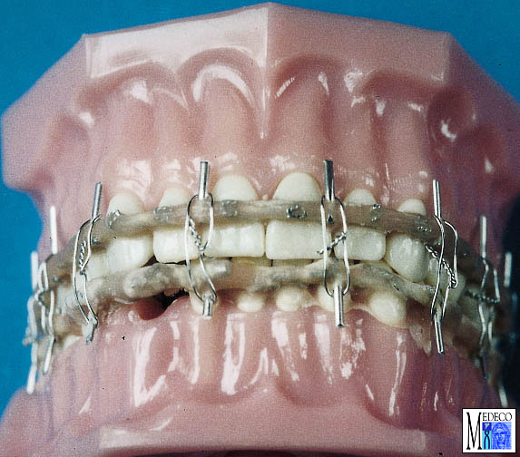 Alveolar process fracture