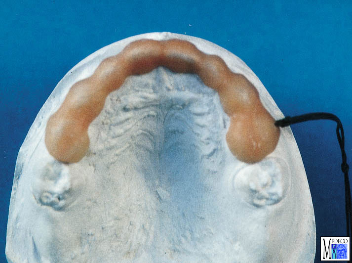 Alveolarfortsatzfraktur