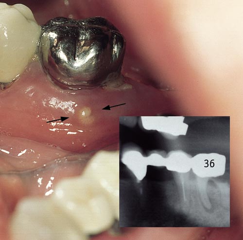 Inflammation after surgical procedures