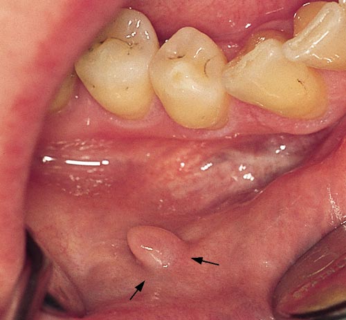 Enfermedades tumorales