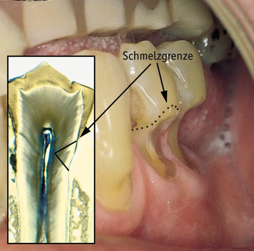 Füllungstherapie bei Zahnschäden